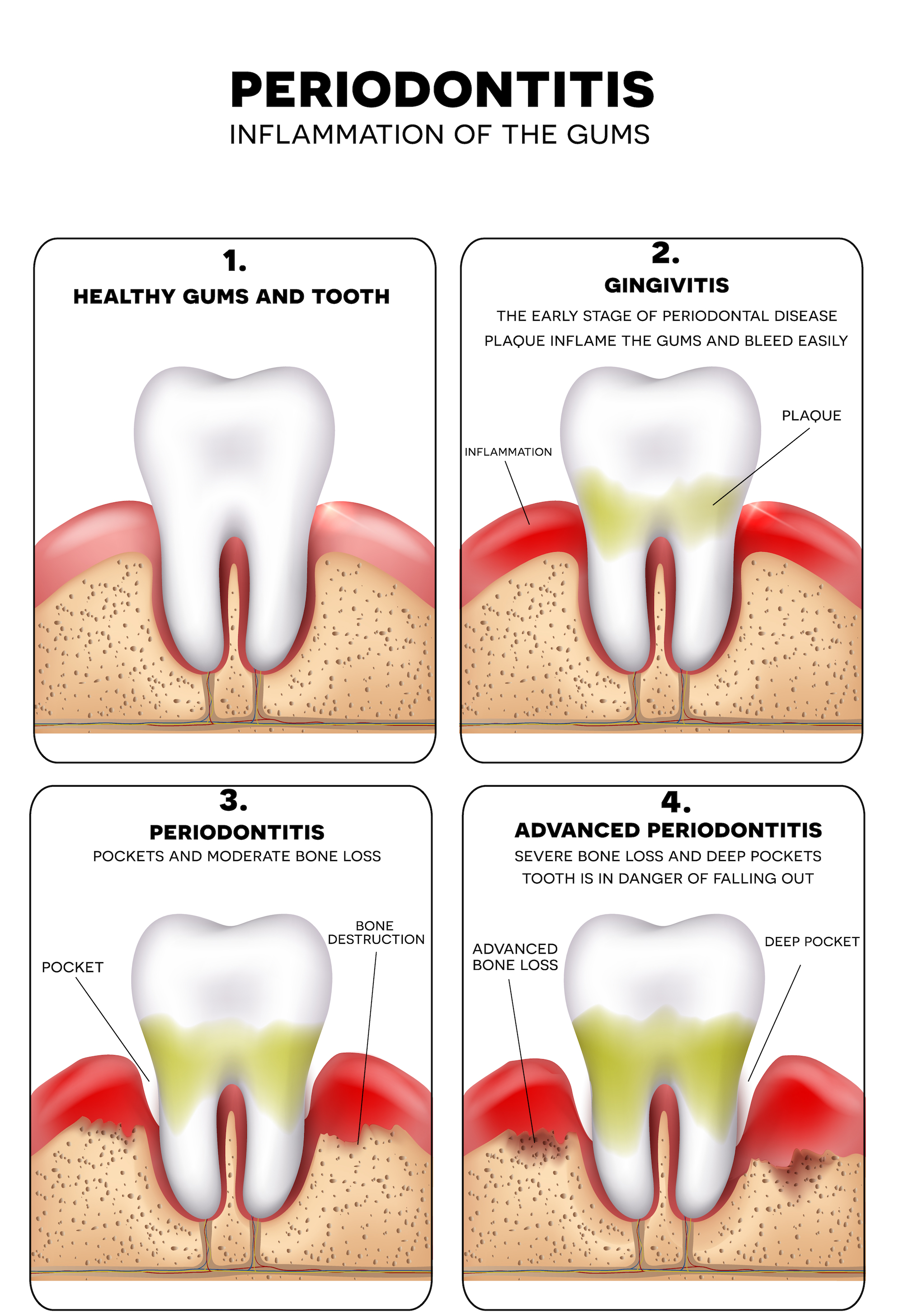 Chronic Periodontitis: Diagnosis, Treatment and Medico Legal Challenges ...